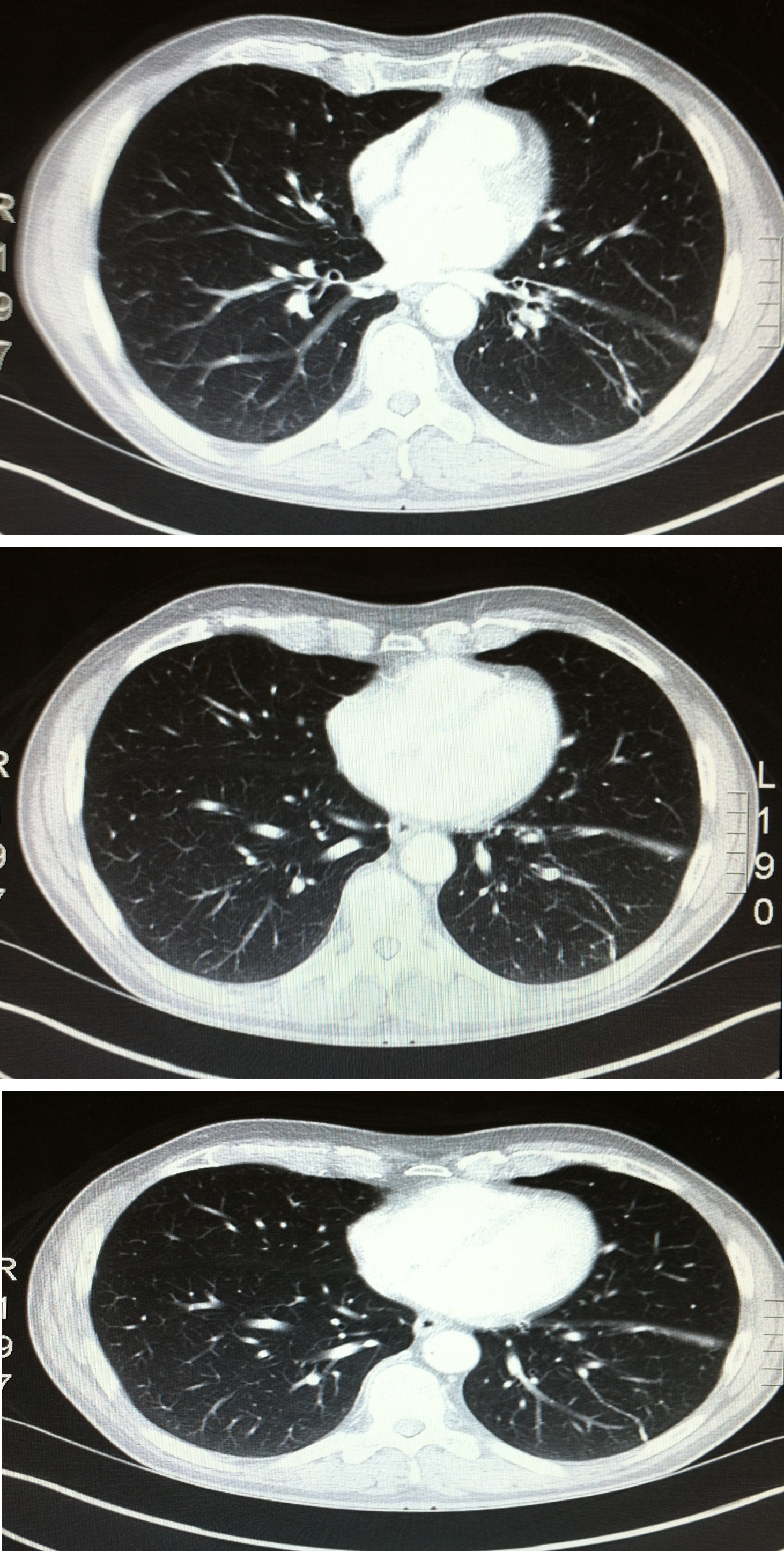 Case Presentation Cardiac Complications After Lung Surgery STS Case Presentation Cardiac Complications After Lung Surgery STS